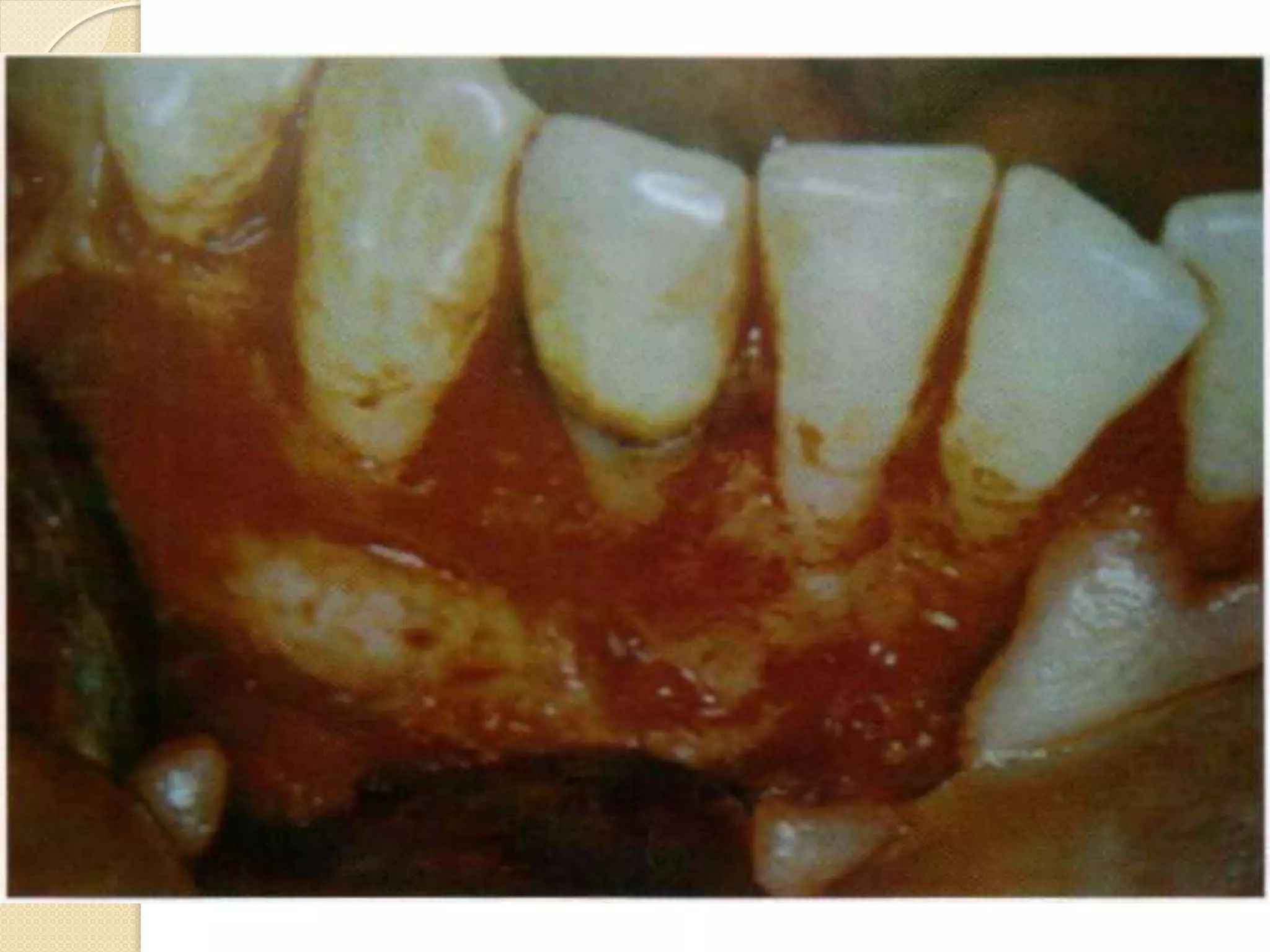 Transalveolar Extraction | PPTX