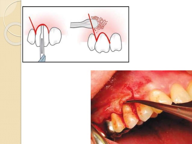 Transalveolar Extraction | PPTX