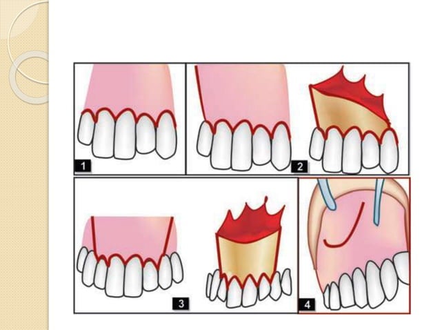 Transalveolar Extraction | PPTX