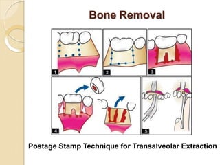 transalveolarextraction-141216013606-conversion-gate01 (1)-converted ...