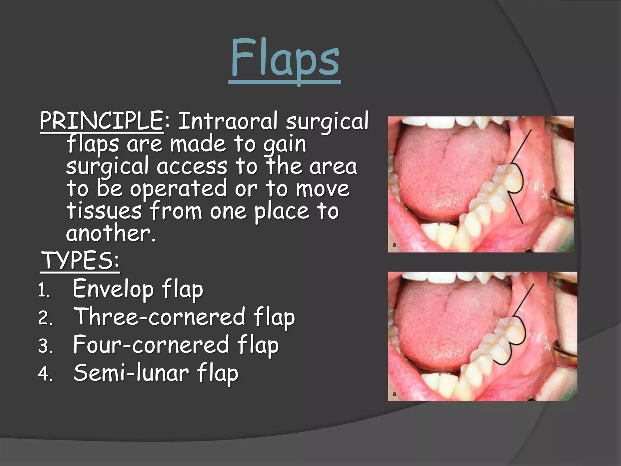 Transalveolar extraction | PPTX