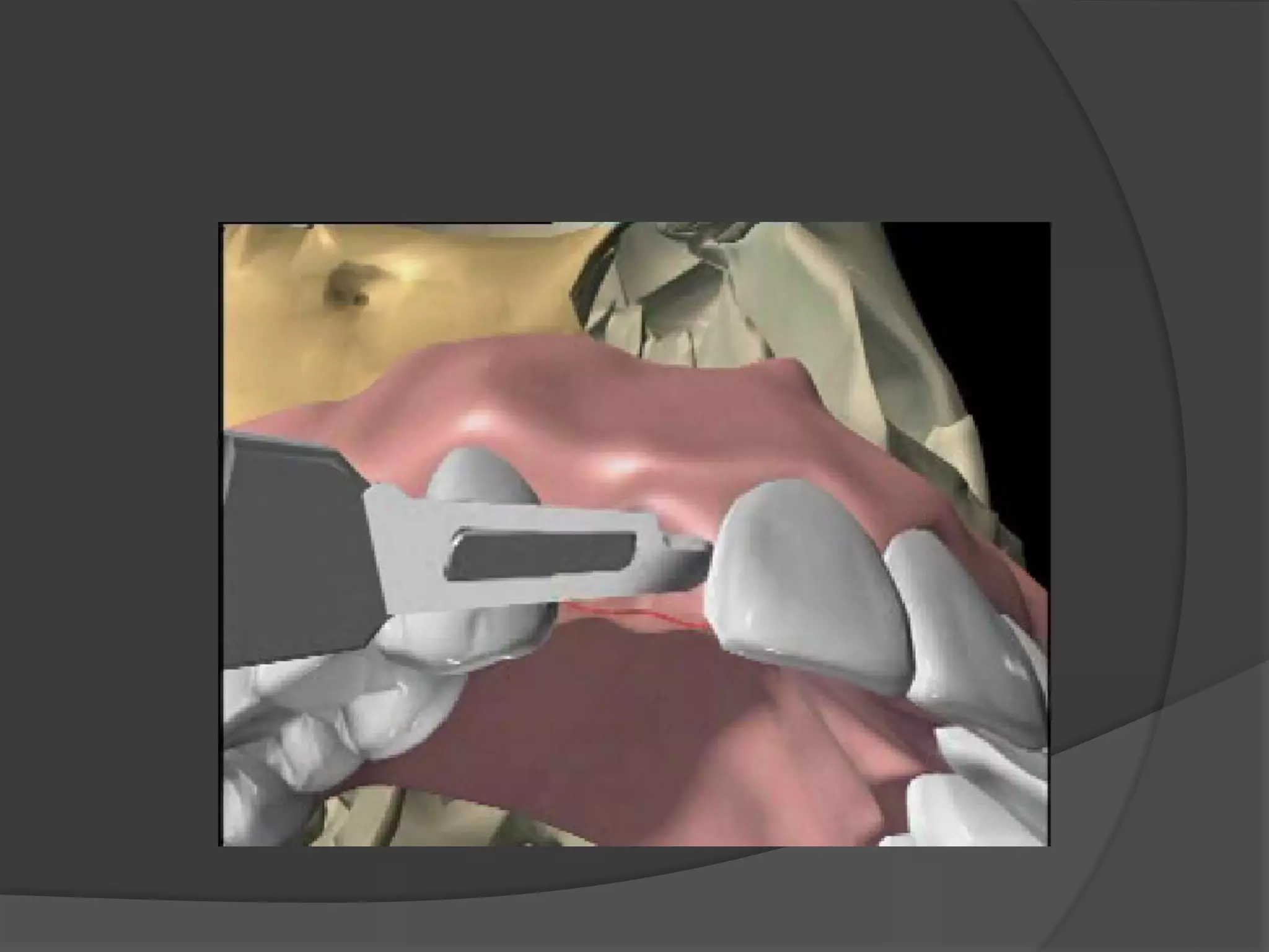 Transalveolar extraction | PPTX