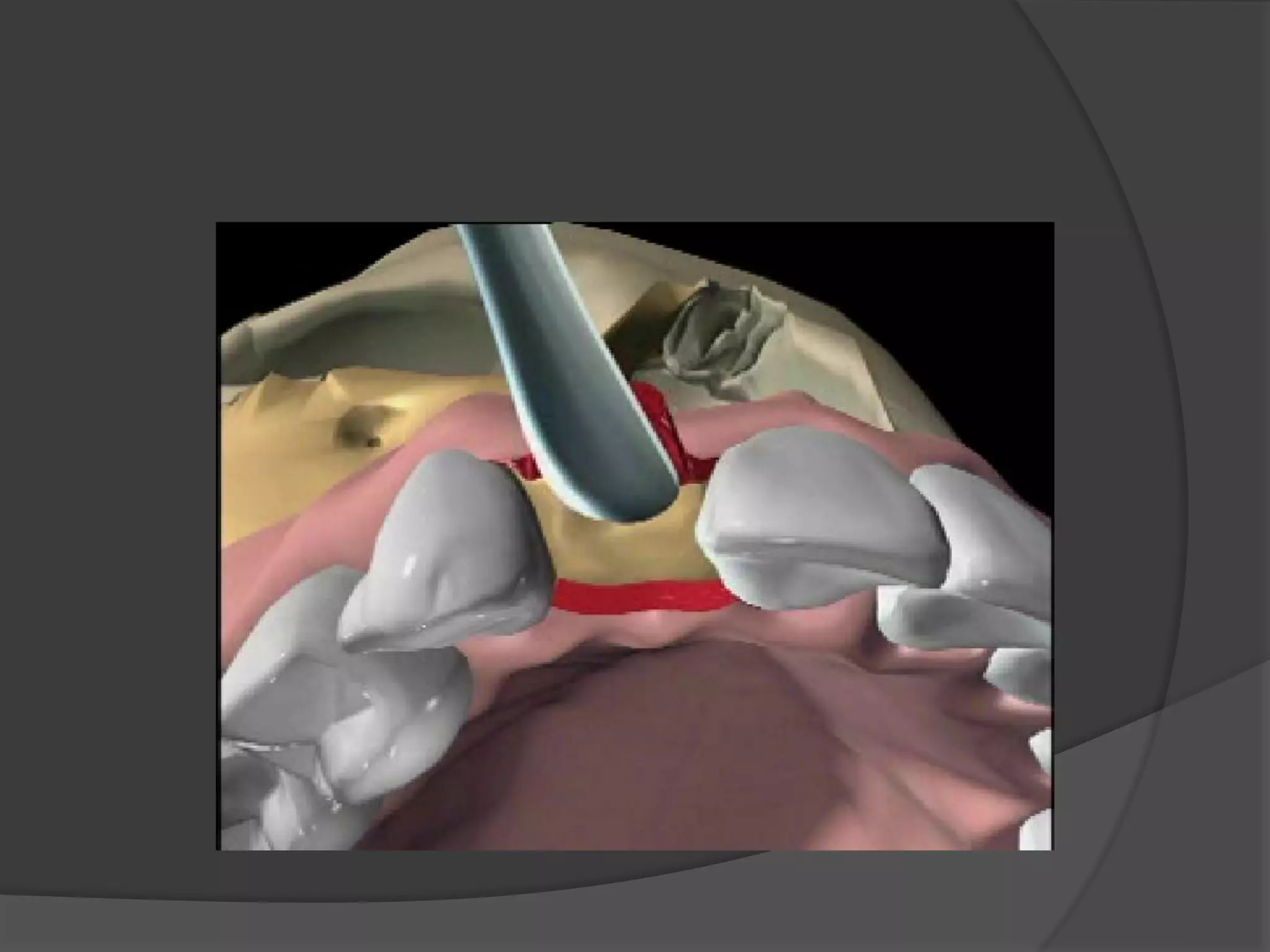 Transalveolar extraction | PPTX