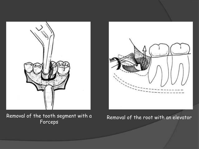 Transalveolar extraction | PPTX | Dental Health | Diseases and Conditions