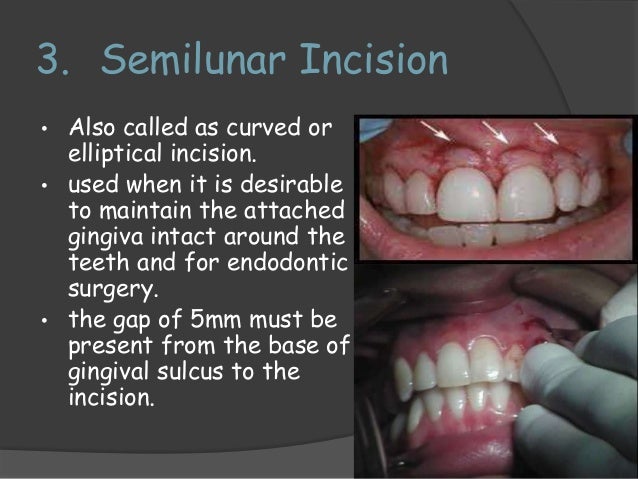 Transalveolar extraction