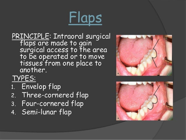 Transalveolar extraction