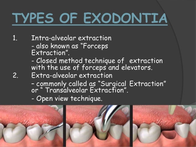 Transalveolar extraction