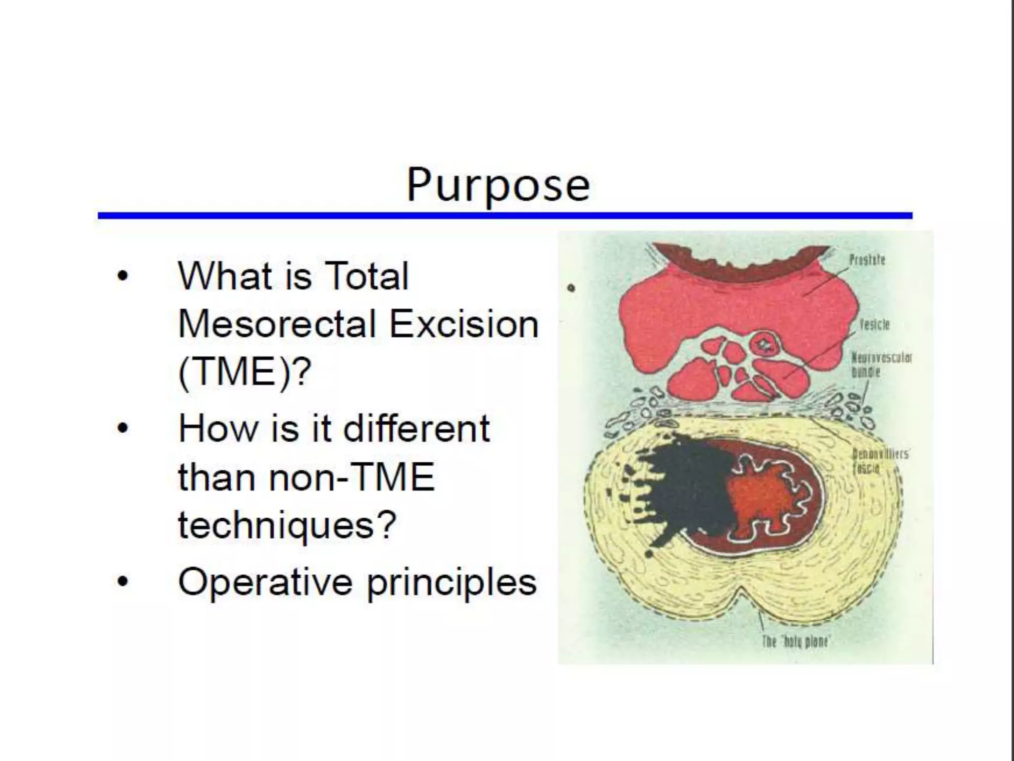 Transanal total mesorectal excision | PPTX