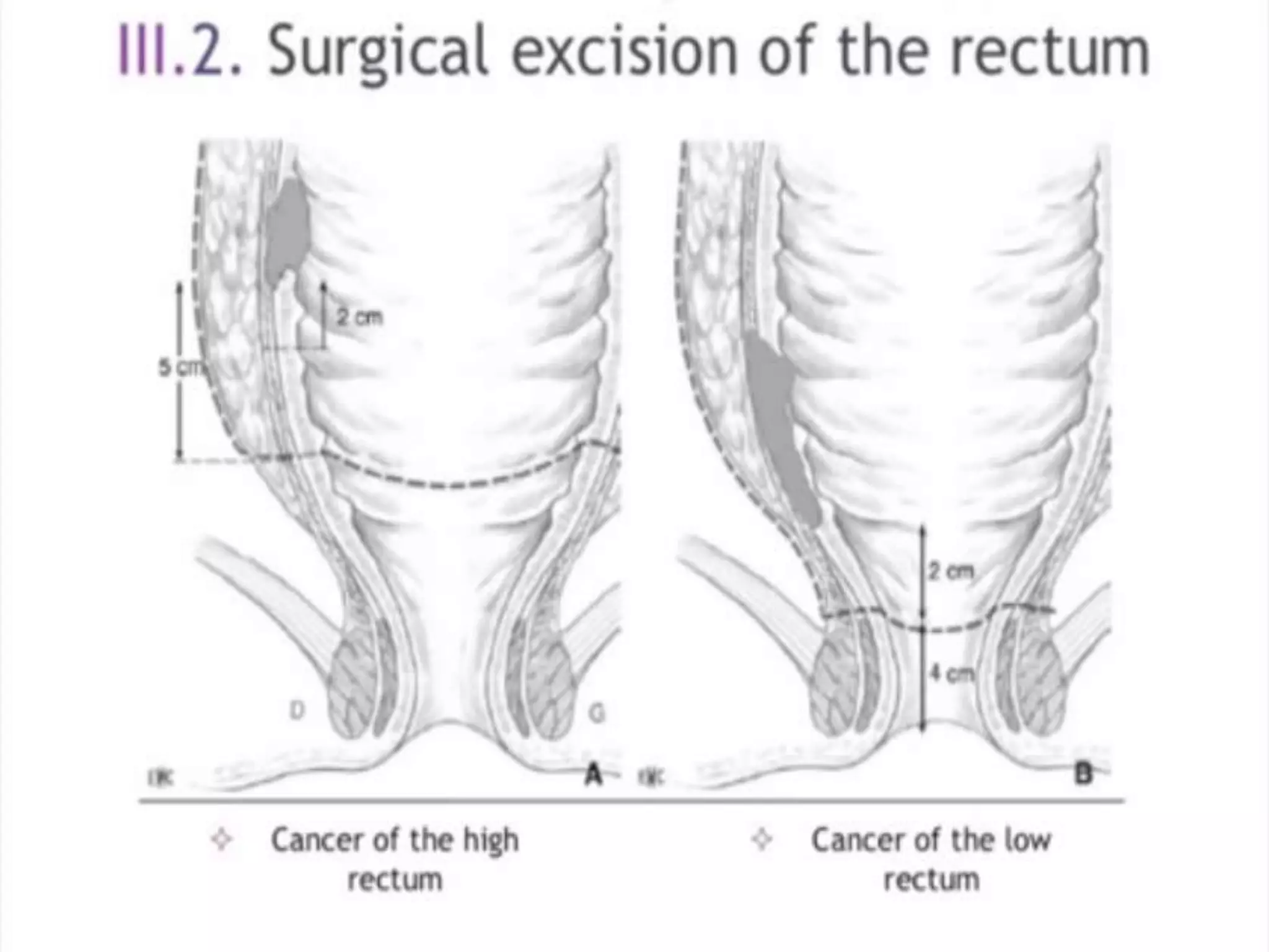 Transanal total mesorectal excision | PPTX