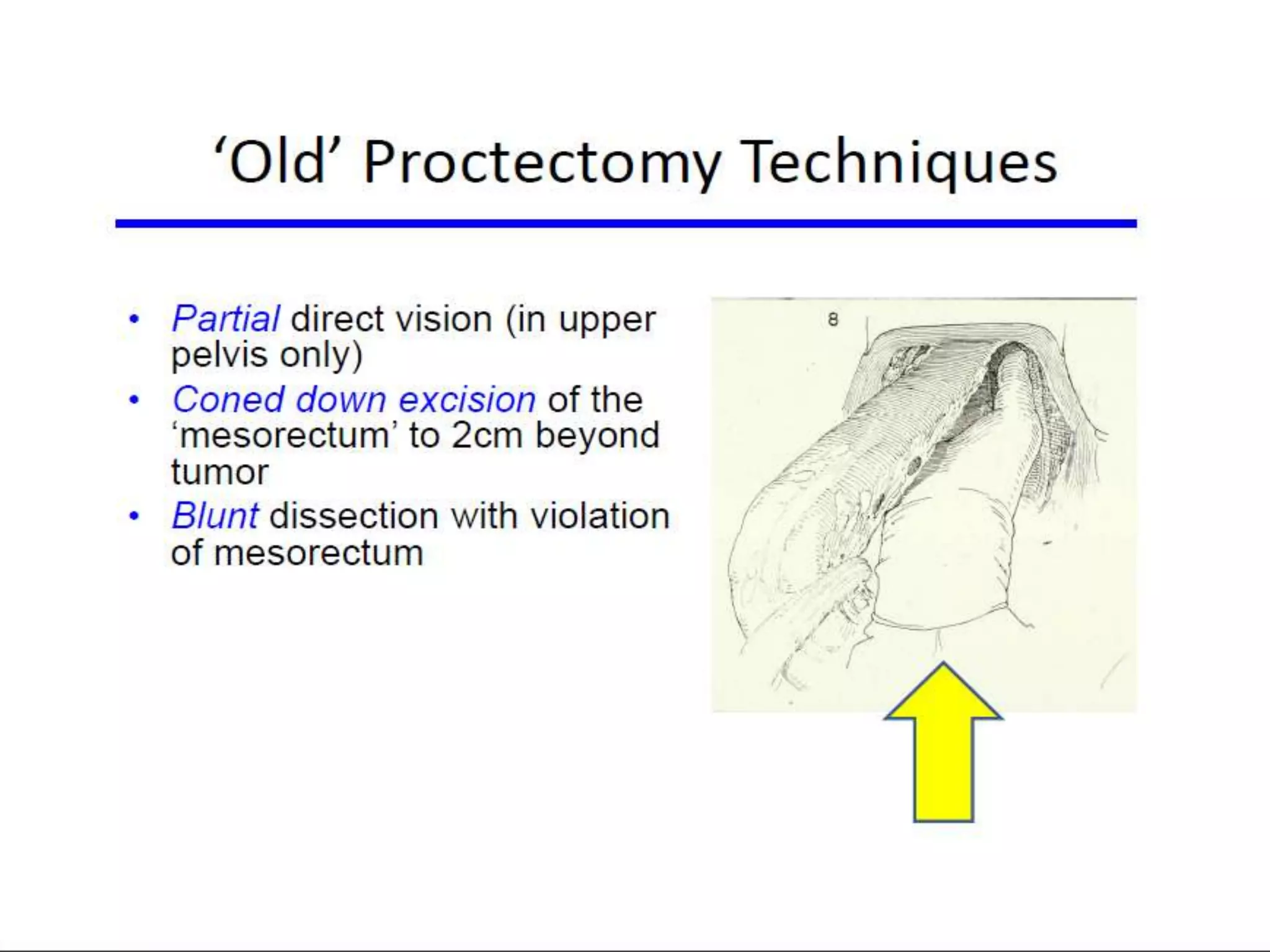 Transanal total mesorectal excision | PPTX