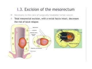 Total Mesorectal Excision