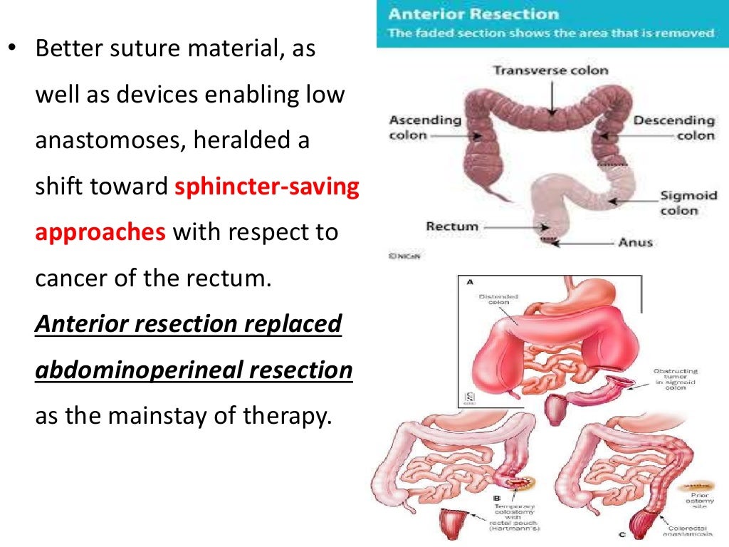 Transanal total mesorectal excision