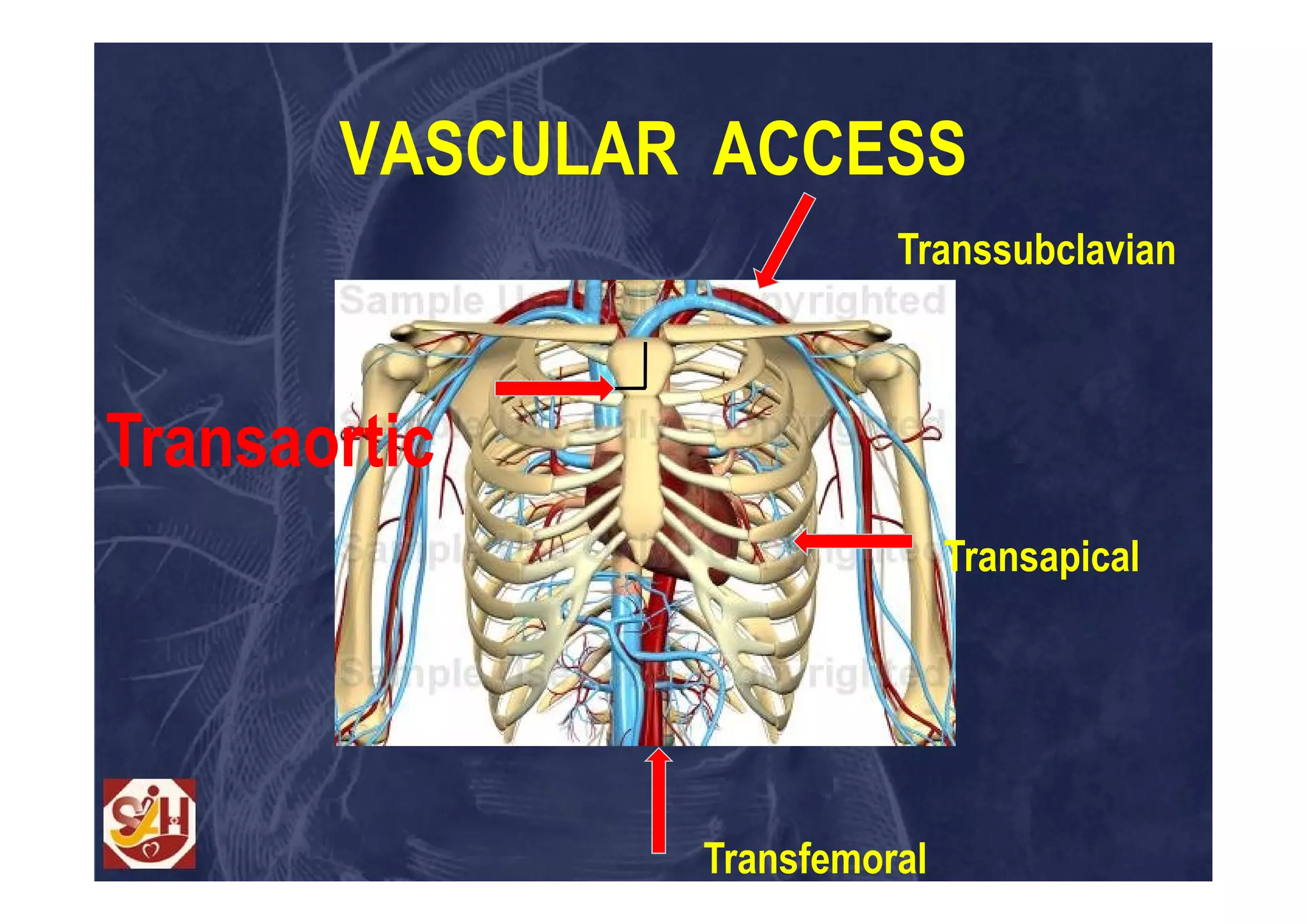 Trans aortic tavi | PDF