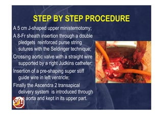 Trans aortic tavi | PDF