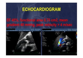 Trans aortic tavi | PDF