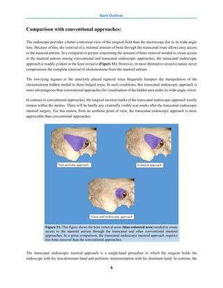Transcanal Endoscopic Mastoid Approach- A new access for the mastoid ...
