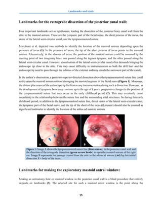 Transcanal Endoscopic Mastoid Approach- A new access for the mastoid ...