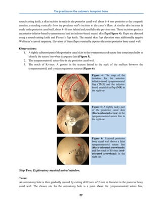 Transcanal Endoscopic Mastoid Approach- A new access for the mastoid ...