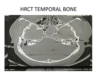 Transcanal facial nerve decompression under local anaesthesia report of ...