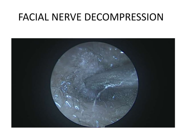 Transcanal facial nerve decompression under local anaesthesia report of ...