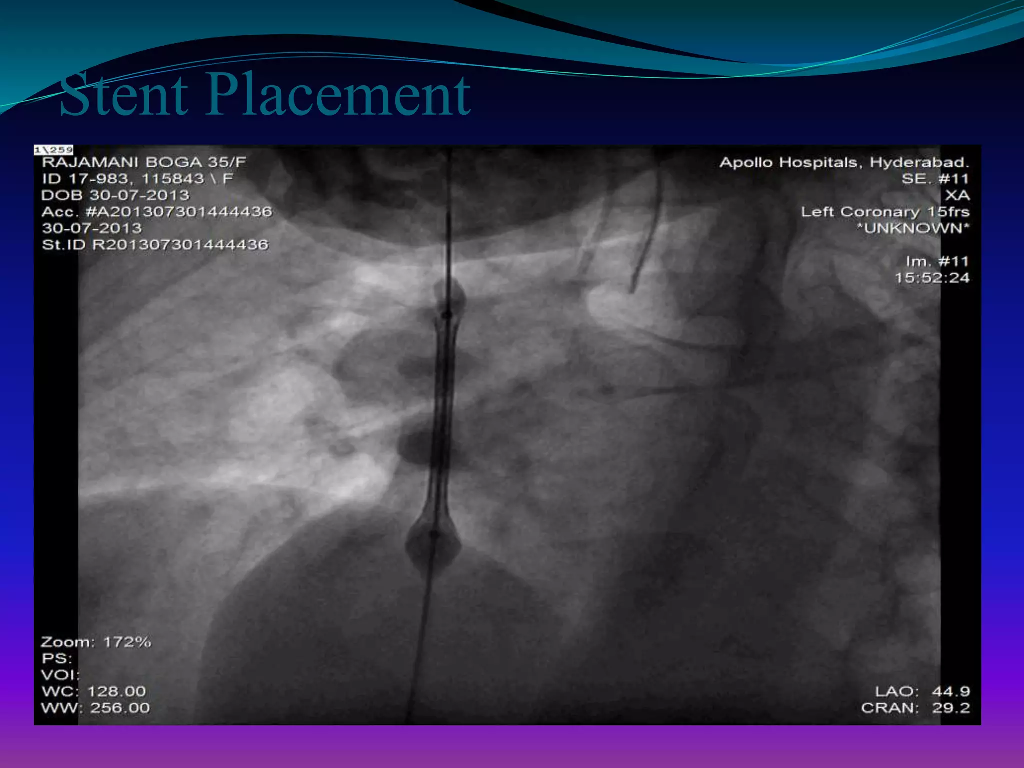 Transcatheter closure of sinus venosus atrial septal defect | PPTX