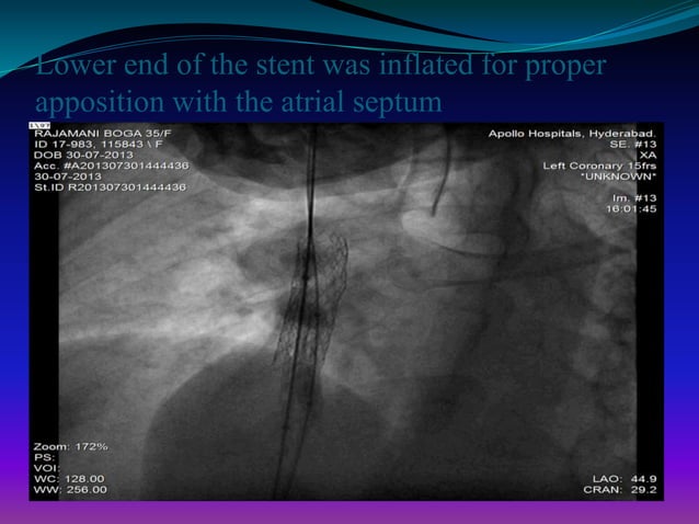 Transcatheter closure of sinus venosus atrial septal defect | PPTX ...
