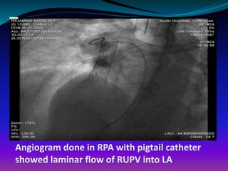 Transcatheter closure of sinus venosus atrial septal defect | PPTX