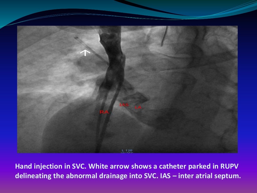 Transcatheter closure of sinus venosus atrial septal defect