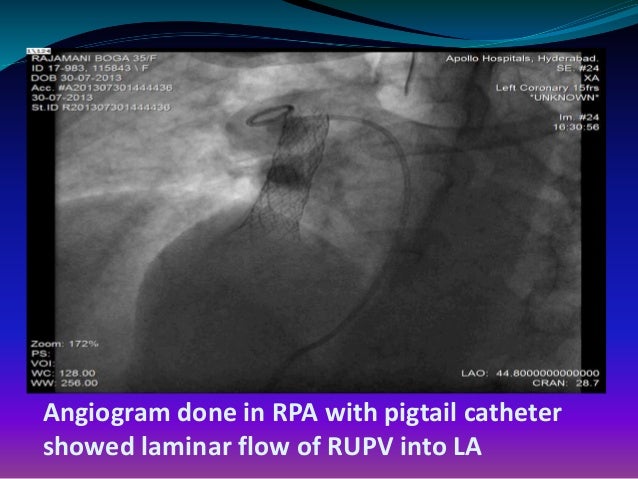 Transcatheter closure of sinus venosus atrial septal defect