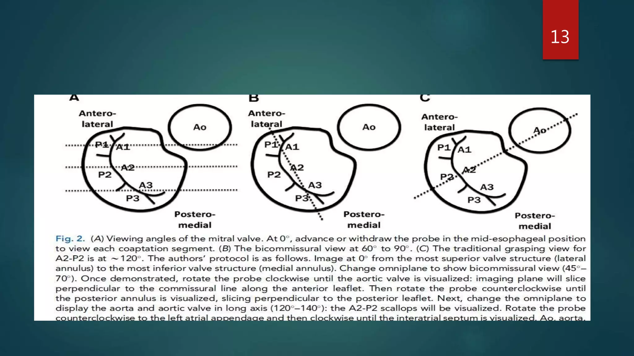 Transcatheter therapy for mitral regurgitation | PPTX