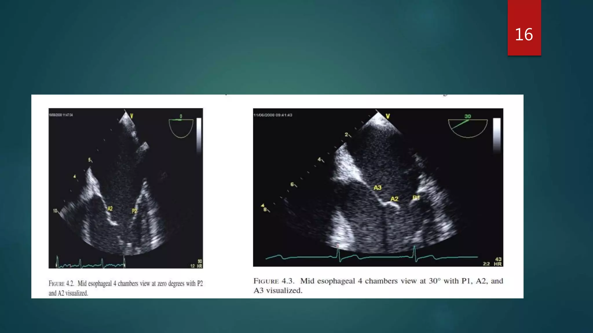 Transcatheter therapy for mitral regurgitation | PPTX