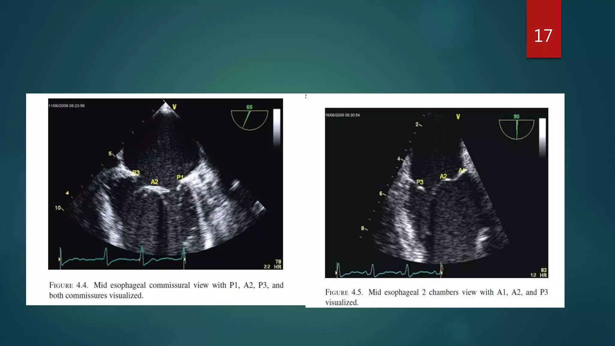 Transcatheter therapy for mitral regurgitation | PPTX