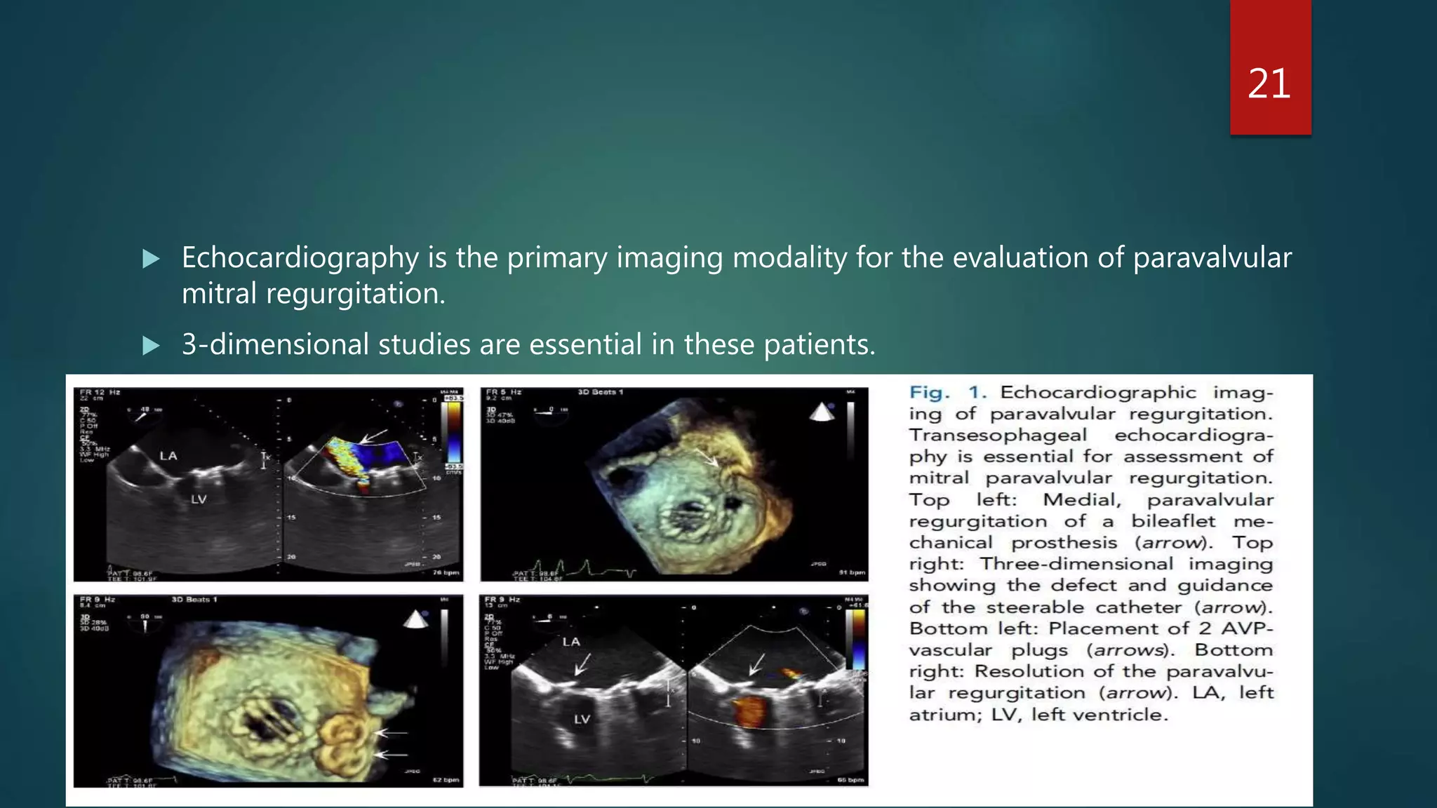 Transcatheter therapy for mitral regurgitation | PPTX