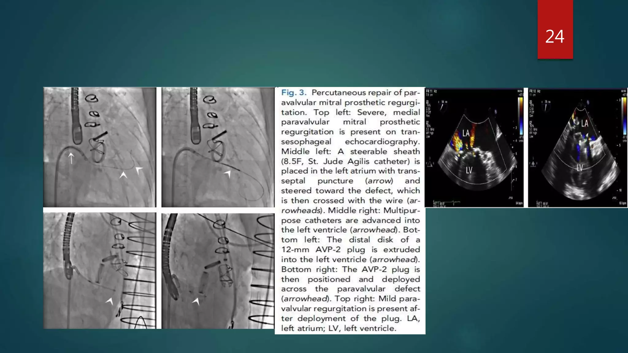 Transcatheter therapy for mitral regurgitation | PPTX