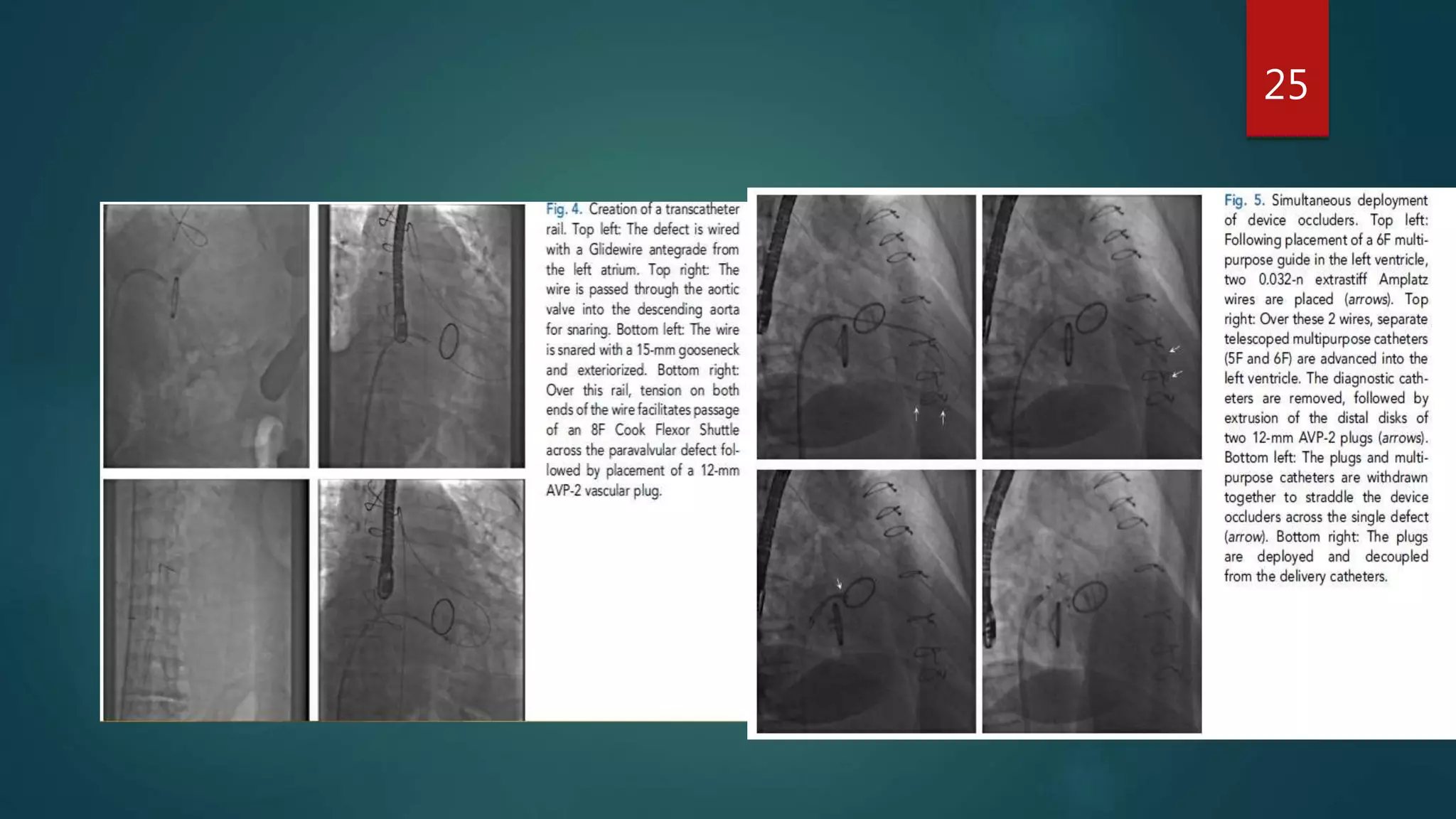 Transcatheter therapy for mitral regurgitation | PPTX