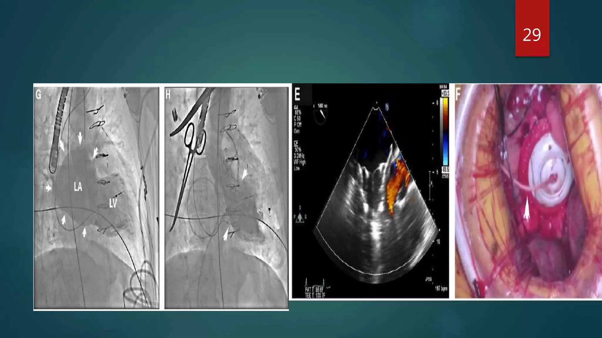 Transcatheter therapy for mitral regurgitation | PPTX