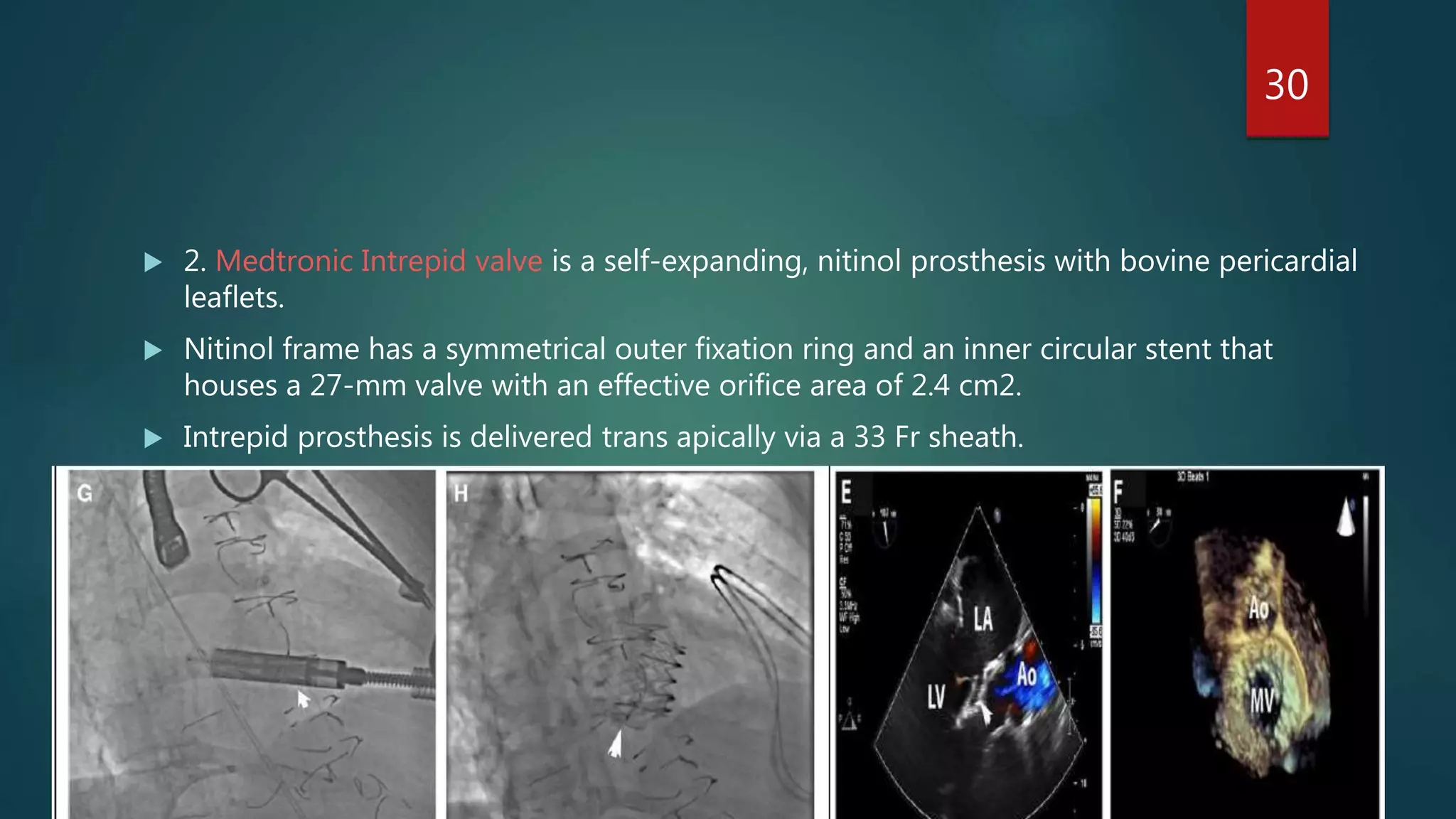 Transcatheter therapy for mitral regurgitation | PPTX