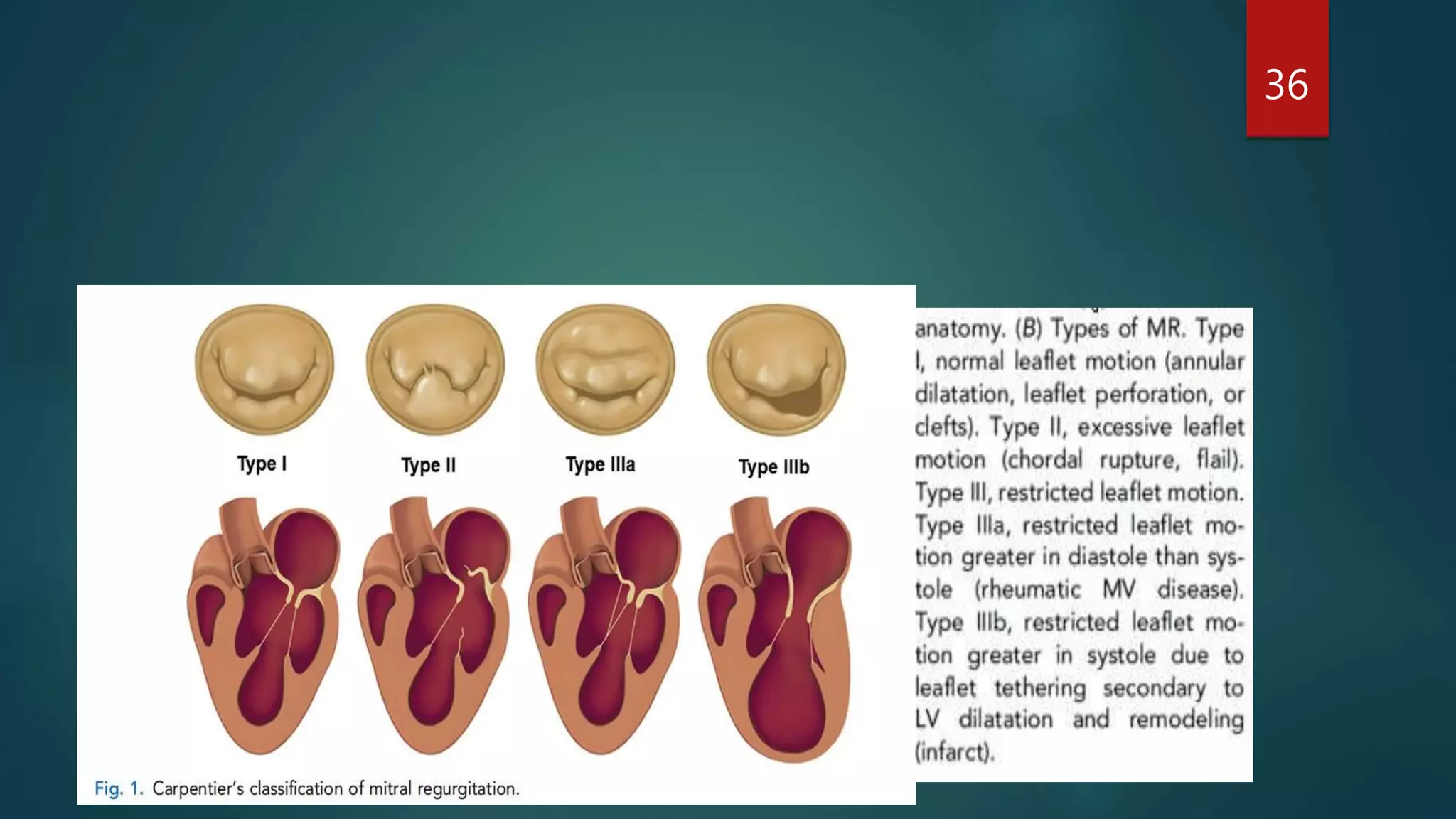Transcatheter therapy for mitral regurgitation | PPTX