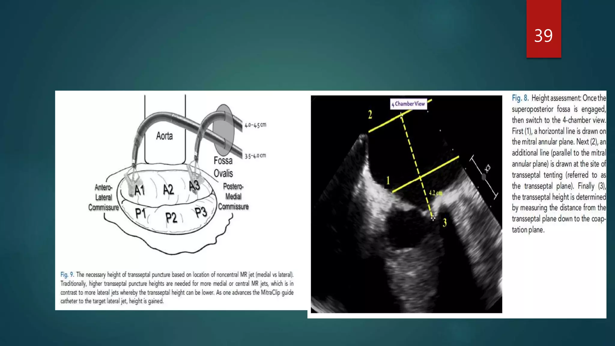 Transcatheter therapy for mitral regurgitation | PPTX