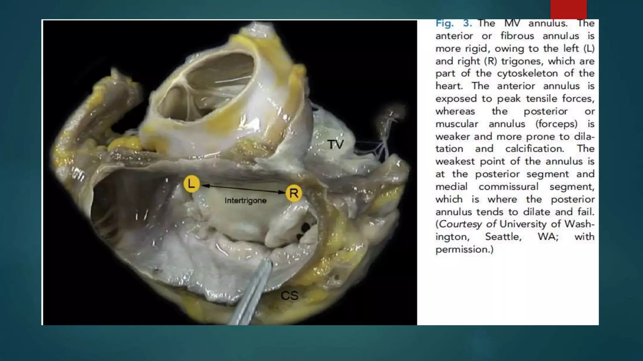 Transcatheter therapy for mitral regurgitation | PPTX