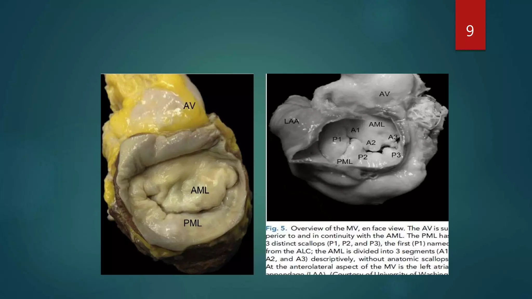 Transcatheter therapy for mitral regurgitation | PPTX