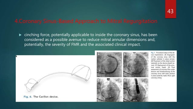 Transcatheter therapy for mitral regurgitation | PPT