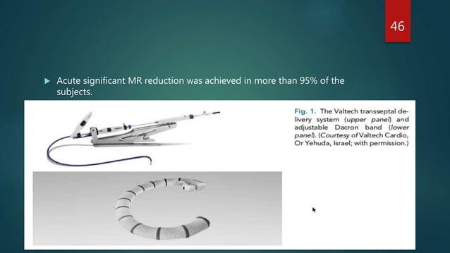 Transcatheter therapy for mitral regurgitation | PPT