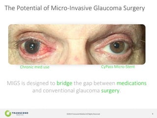 Transcend Medical | PPT