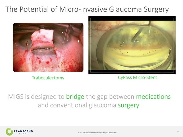 Transcend Medical | PPT