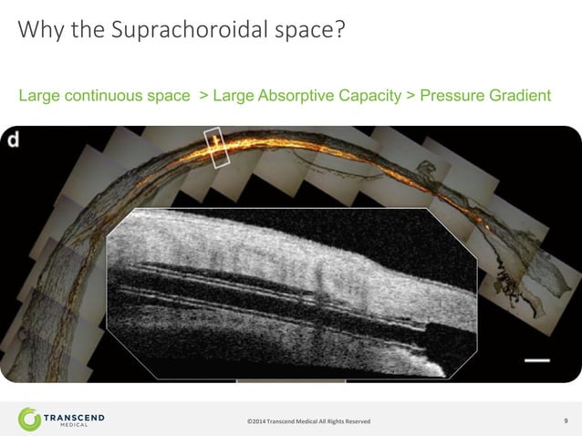 Transcend Medical | PPT