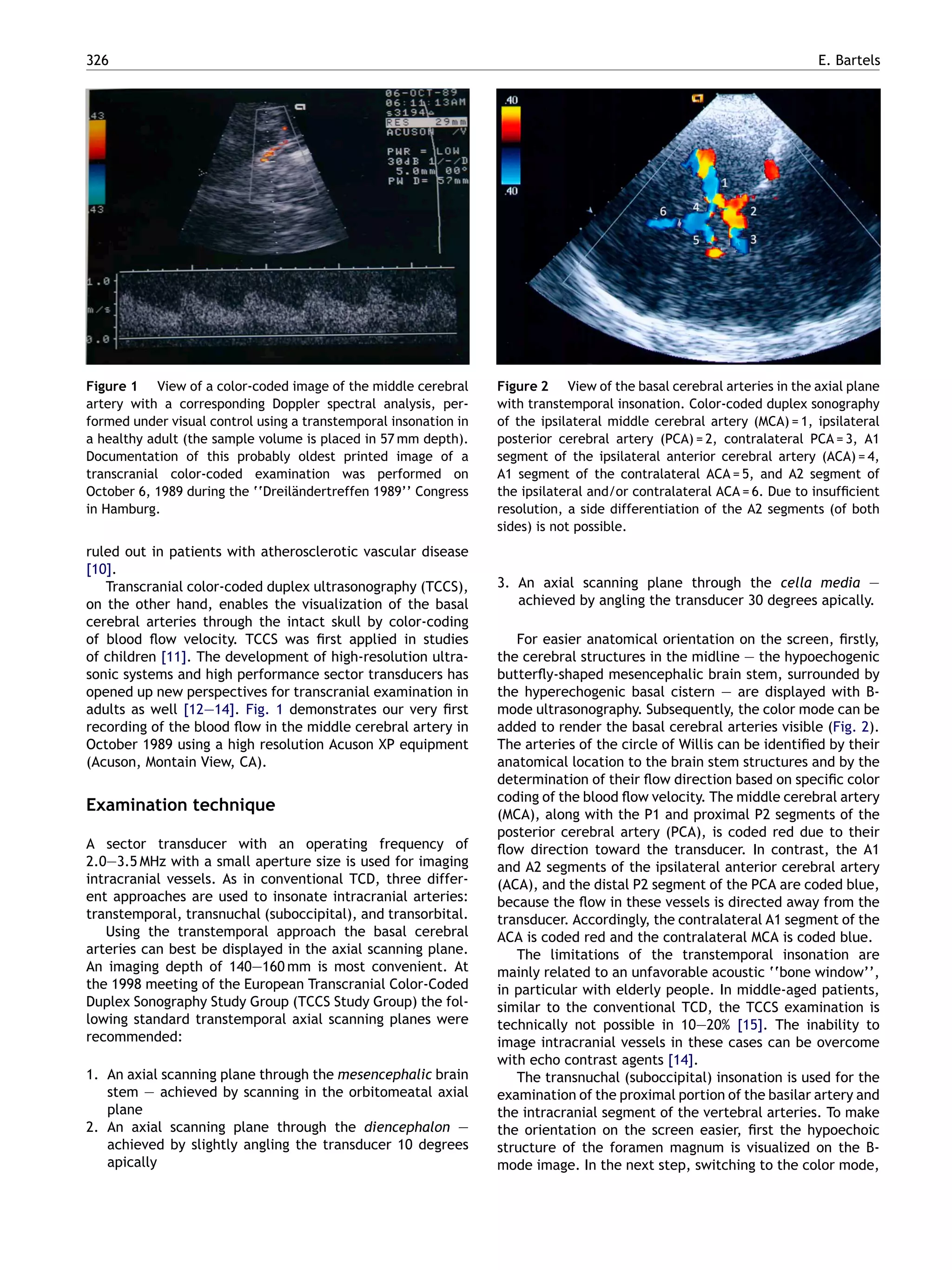 Transcranial color coded duplex ultrasonography in routine cerebrovascular diagnostics | PDF