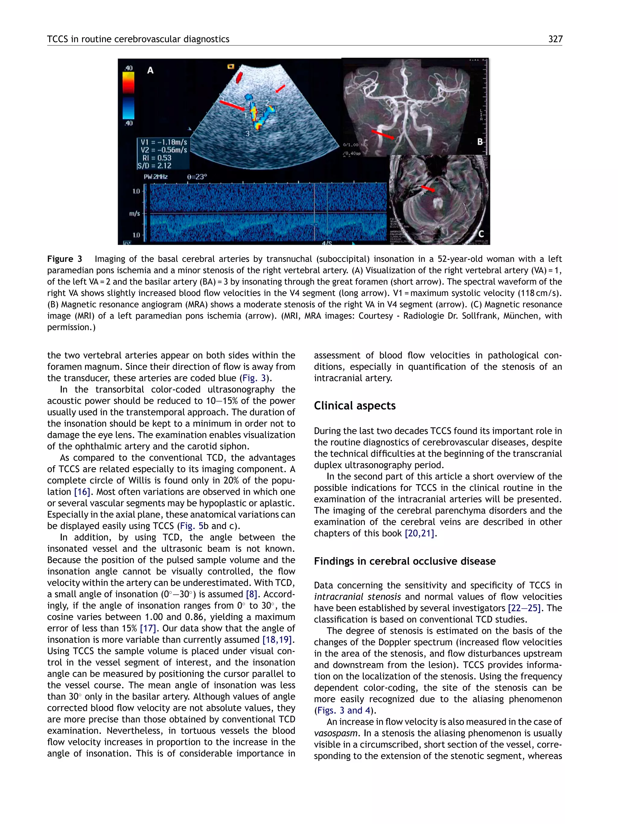 Transcranial color coded duplex ultrasonography in routine ...