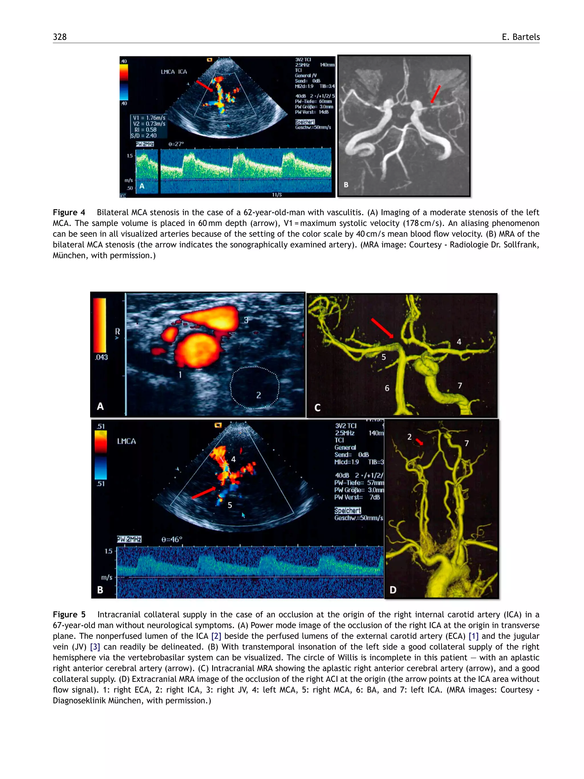 Transcranial color coded duplex ultrasonography in routine ...