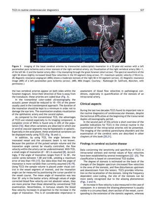 Transcranial color coded duplex ultrasonography in routine ...